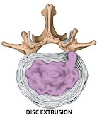 Hernia disku (vyskočená platnička): Typy, príznaky, liečba | Fymas